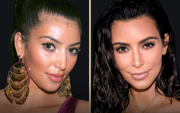Kim Kardashian Botox Antes Y Después Del 'baby Bótox' A Las